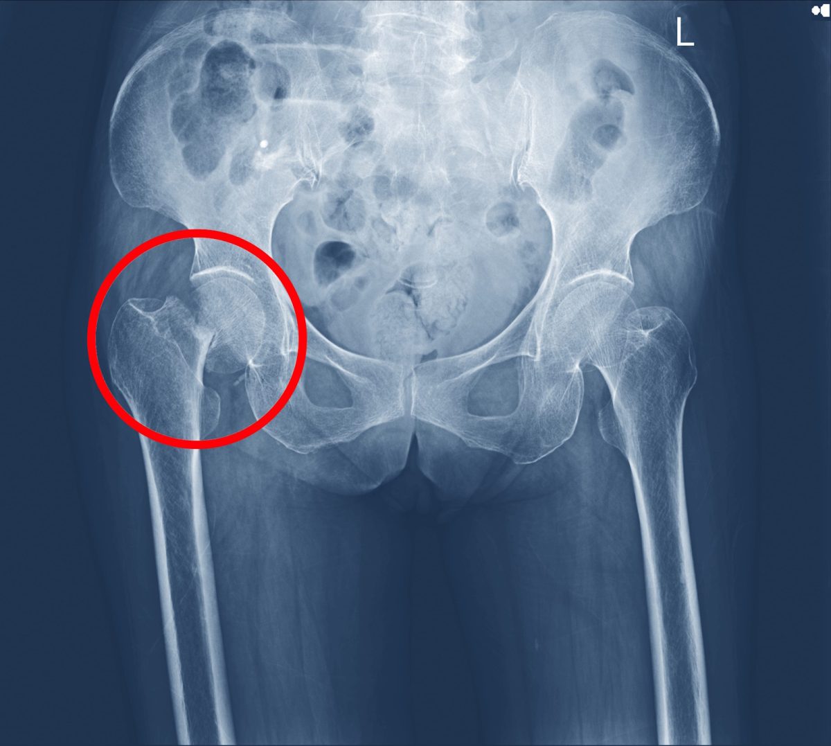How Much Compensation For A Broken Hip?