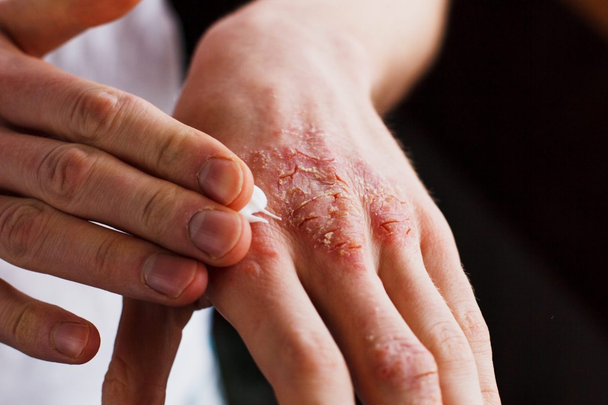 Skin Condition Claims – How Much Compensation Could I Claim?